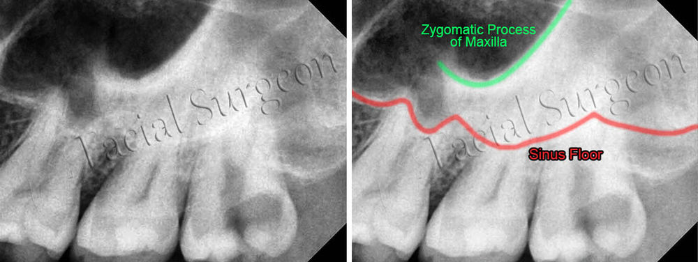 Caldwell-Luc Surgery
