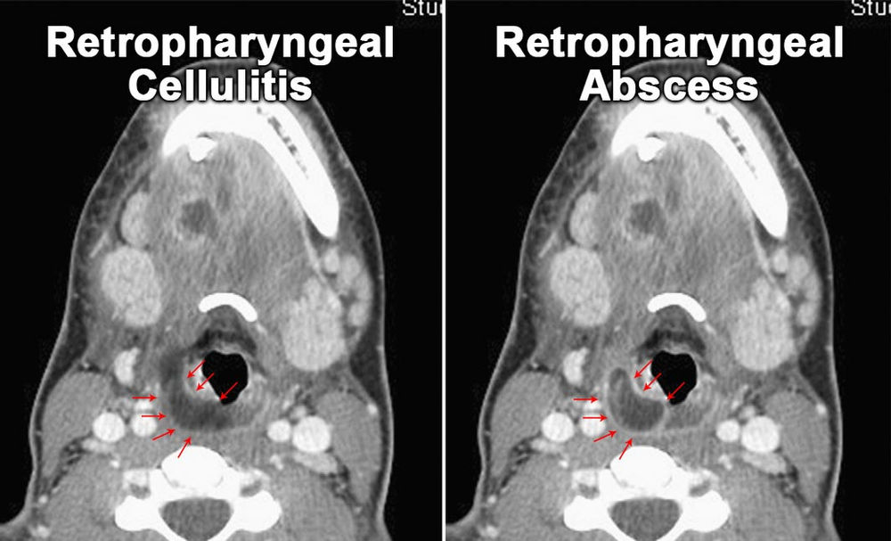 Head & Neck Space Infection