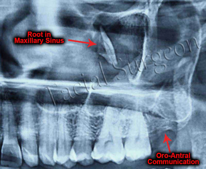 Caldwell-Luc Surgery