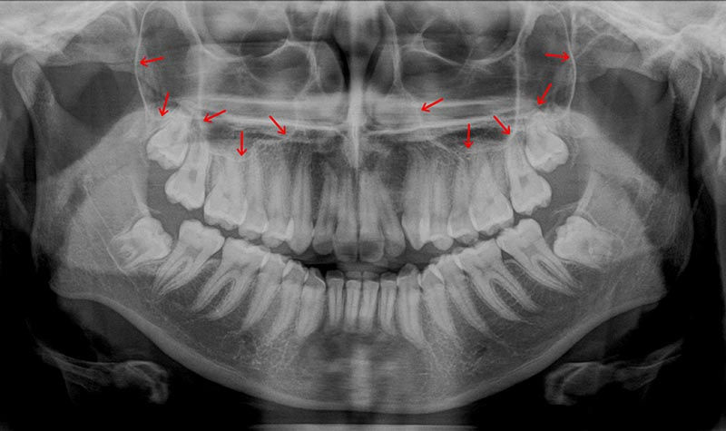 Maxillary Sinus & Molar Roots Relationship