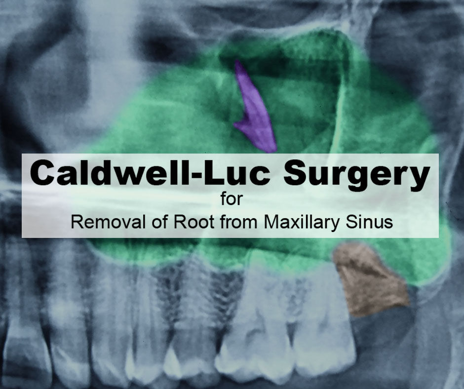Caldwell-Luc Surgery