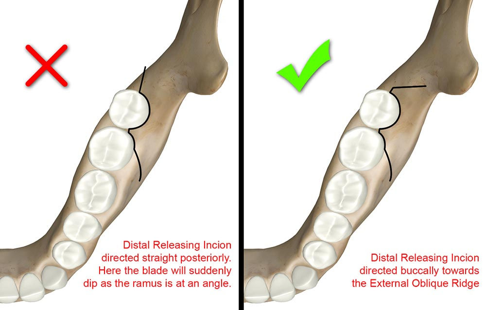 Vital Structures around Mandibular Third molar