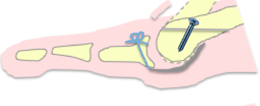 Patient Information about Plantar Plate Repair