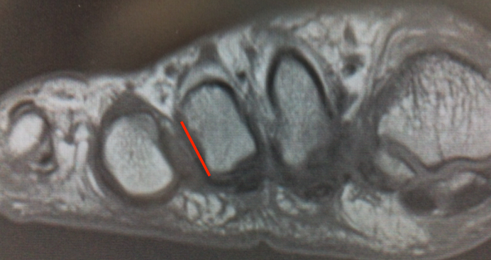 Mortan's Neuroma Excision Patient Info