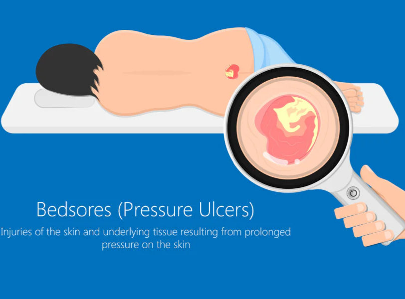 Living with Pressure Ulcers? How Our Texas Wound Care Solutions Make ...