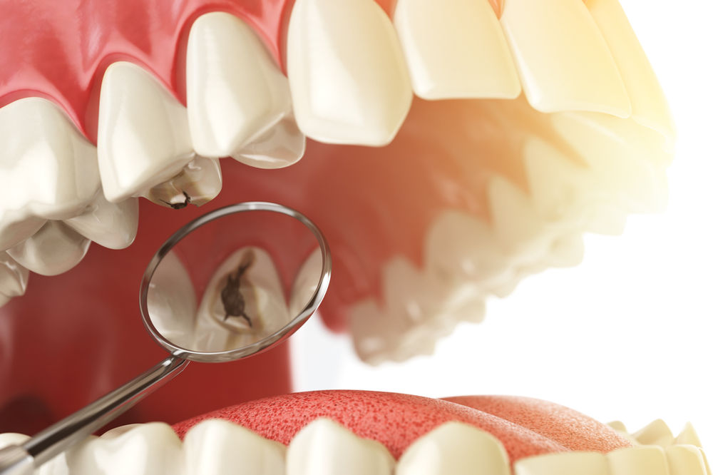 What is Cariogenicity? Learn What Foods Cause Cavities, with Lewisville ...