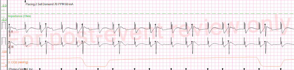 Transcutaneous Pacing: Part 2