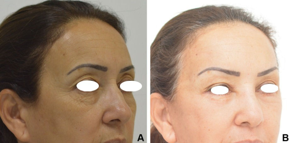 Brow Gliding: Elevating Eyes with Non-Surgical Precision