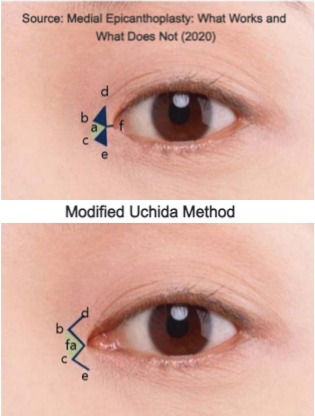 Medial Epicanthoplasty: Key Technique for Patients with Monolid