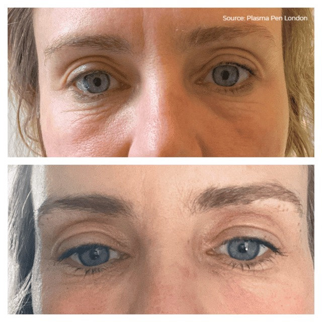 Plasma Technology: Key to Non-Surgical Eye and Facial Rejuvenation
