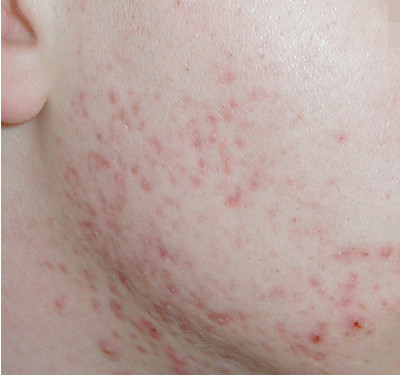 DMK Enzyme Therapy St. Louis | The Healing Hamsa Spa