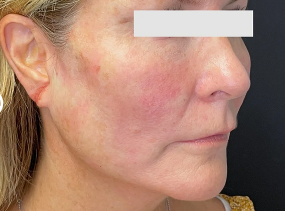 PDO Non-Surgical Thread Lift in Johnston and Zanesville, OH | Freya ...