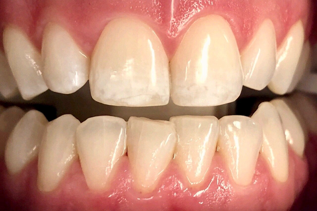 Before / Afters | Smile Transformation Gallery | Dr Whyte Smile