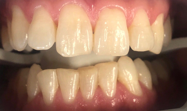 Before / Afters | Smile Transformation Gallery | Dr Whyte Smile