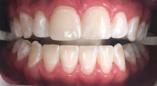 Before / Afters | Smile Transformation Gallery | Dr Whyte Smile