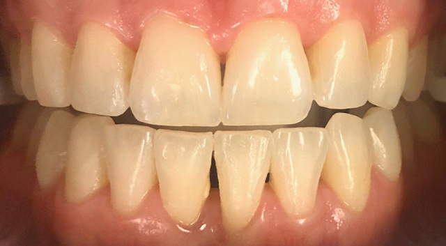 Before / Afters | Smile Transformation Gallery | Dr Whyte Smile