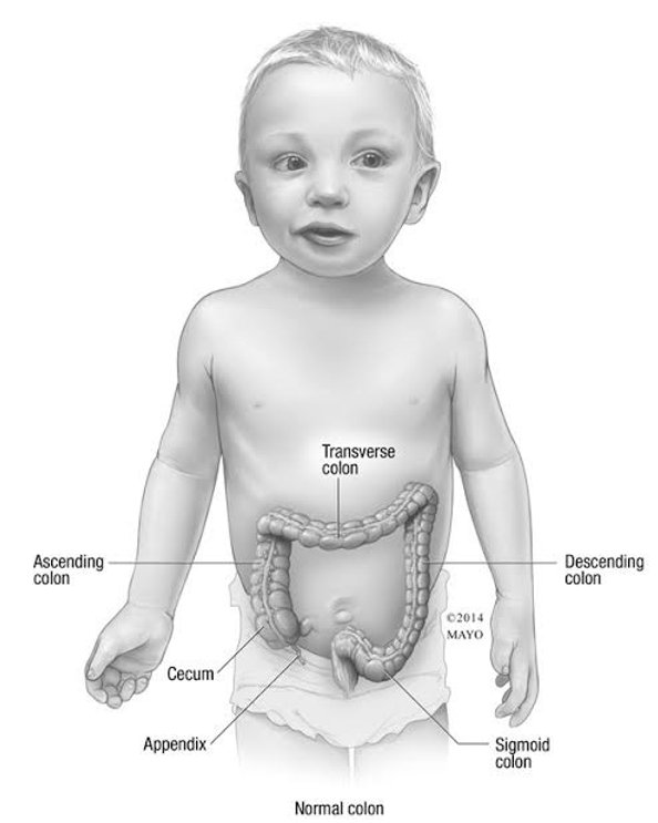 Appendicitis in children