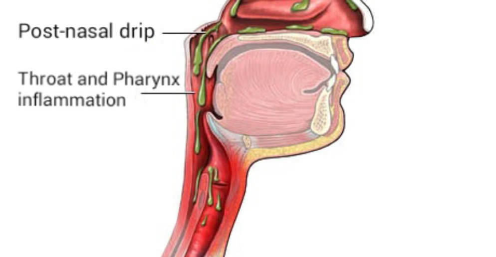 Post nasal drip