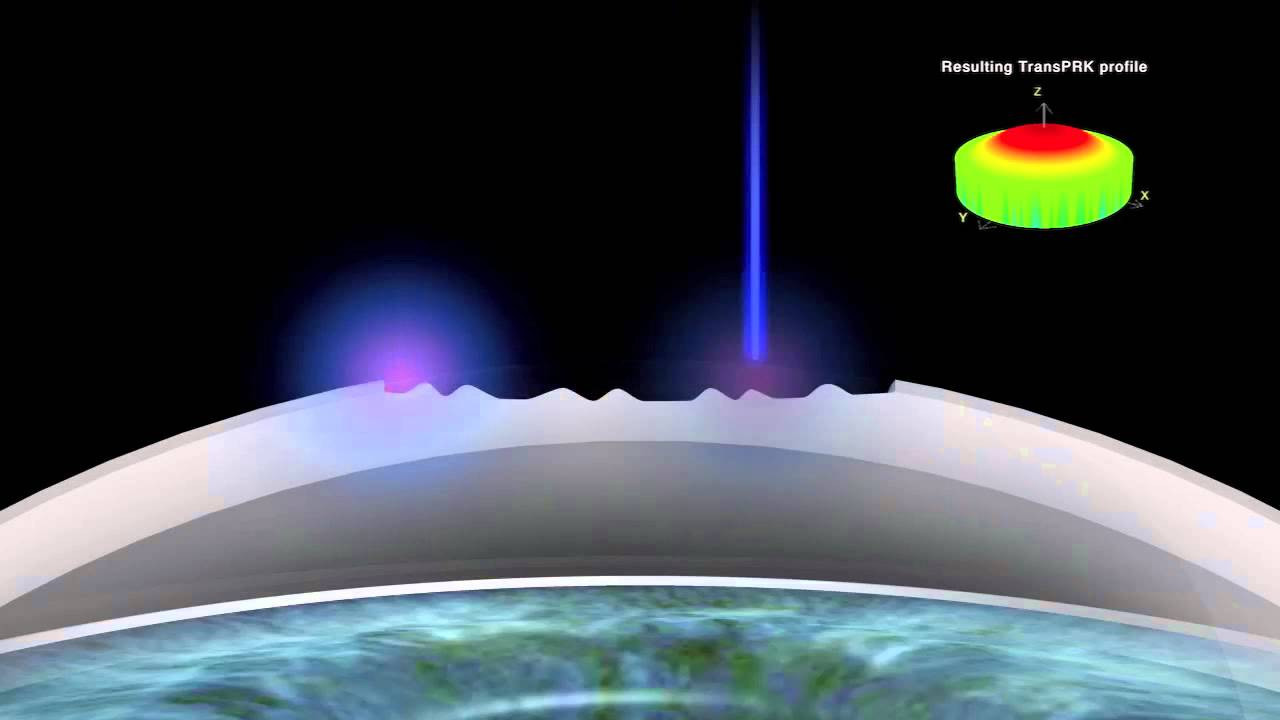 Trans PRK Laser | Eye Unit Οφθαλμολογικό Ιατρείο | Παλαιό Φάληρο