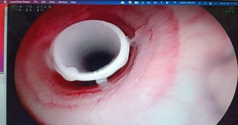 Parálisis Laríngea