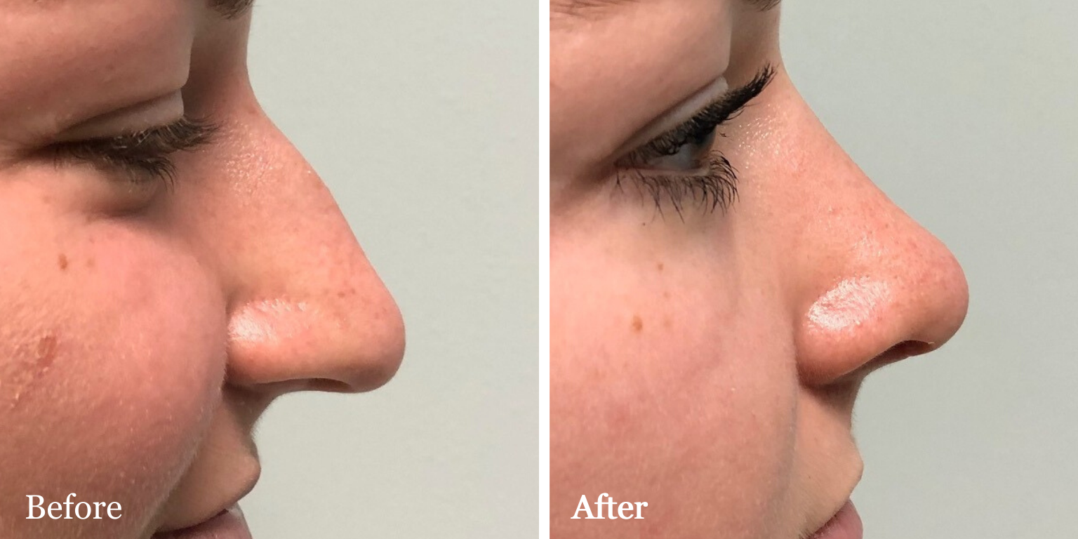 Rhinoplasty Recovery Tips
