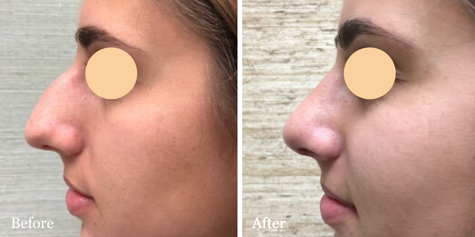 Rhinoplasty Recovery Tips