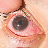 vitritis eye