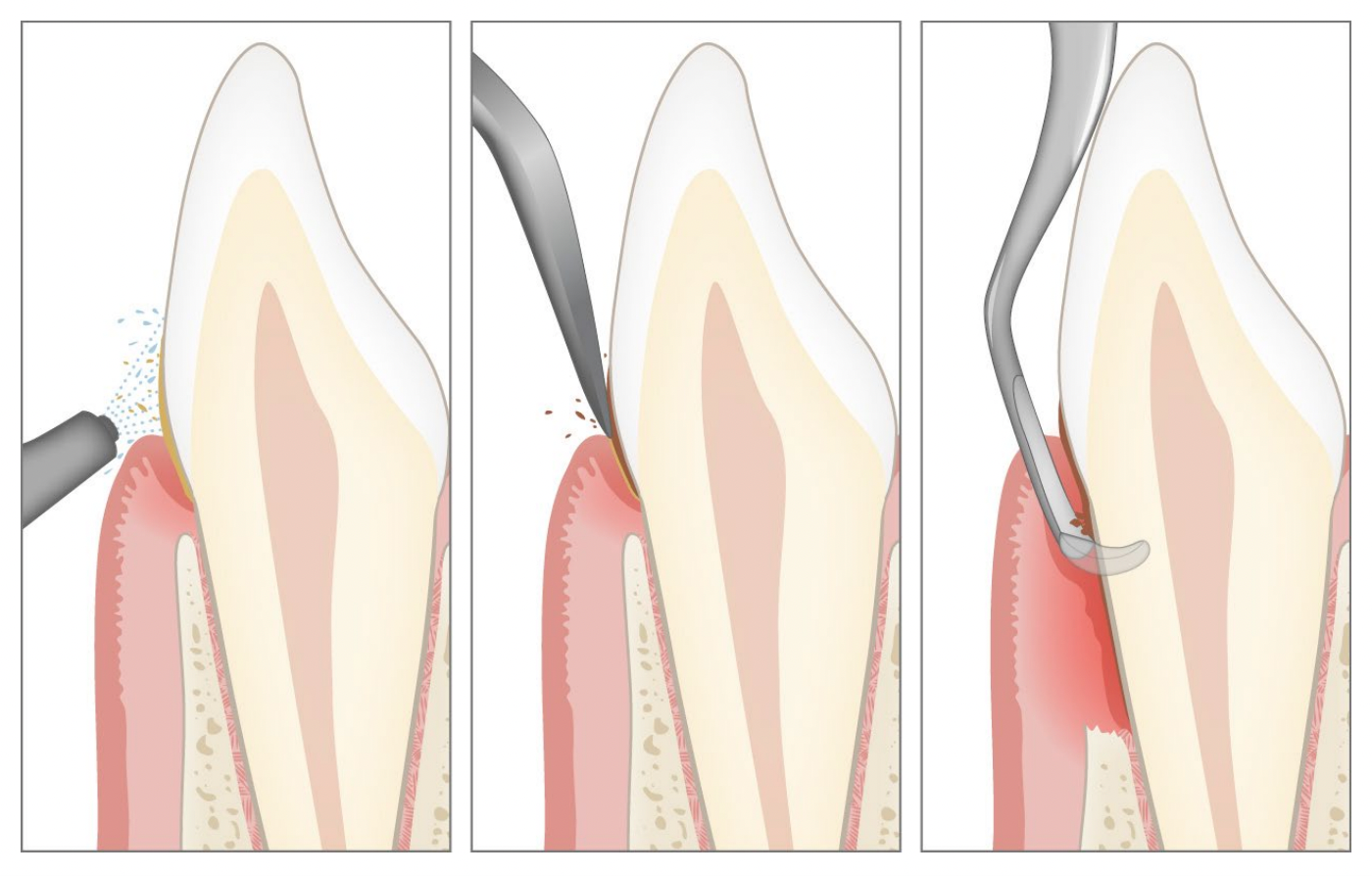 Therapie der Parodontitis | Zahnarztpraxis Dr. Barbara Lehmann ...