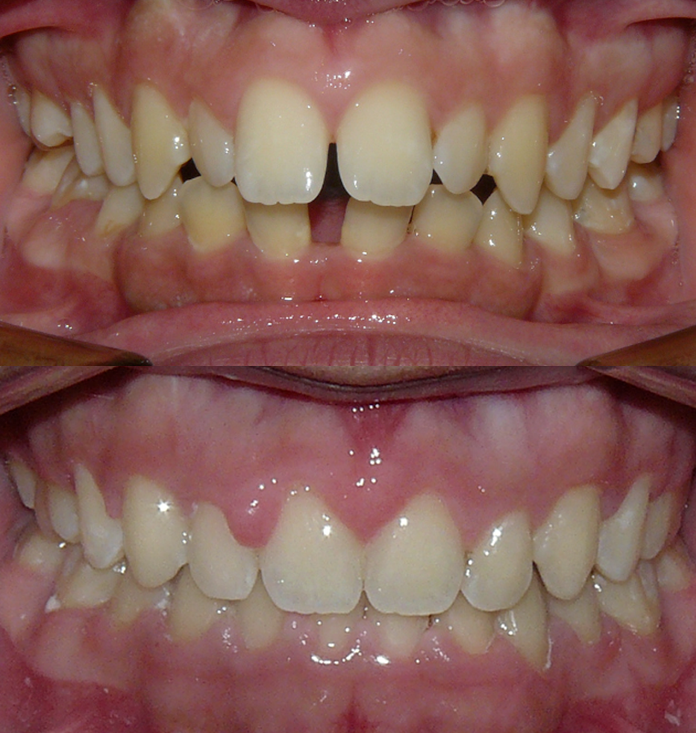 What is overjet an overbite and why does it matter?