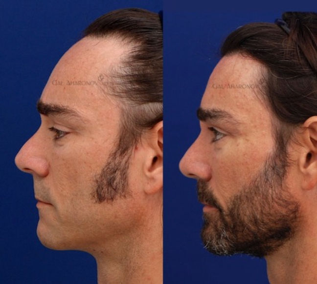 Hairline Lowering Surgery | Forehead Reduction Surgery
