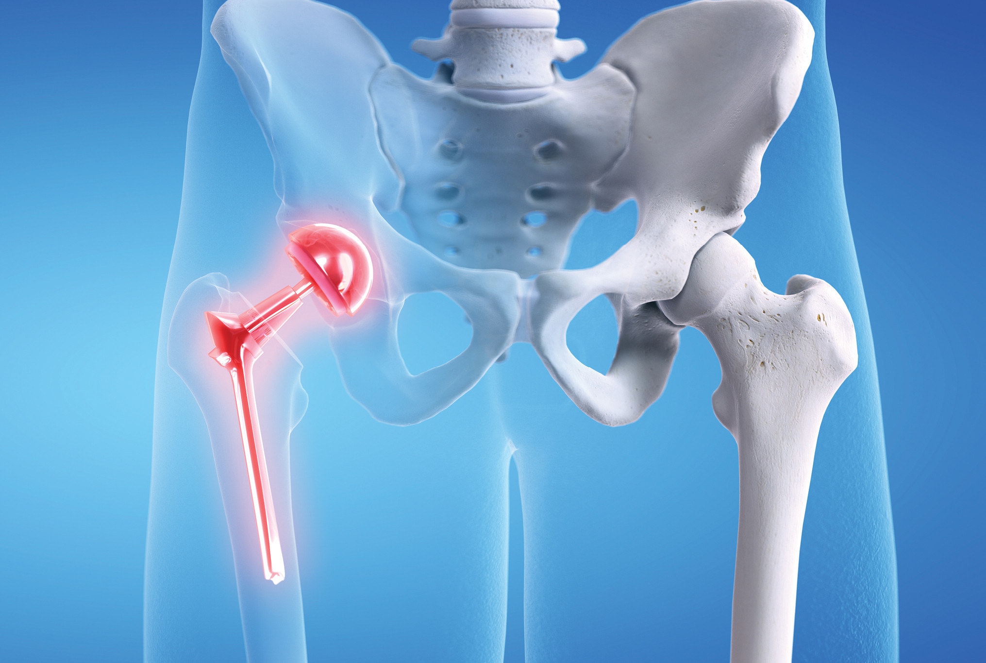 Pickleball After a Joint Replacement