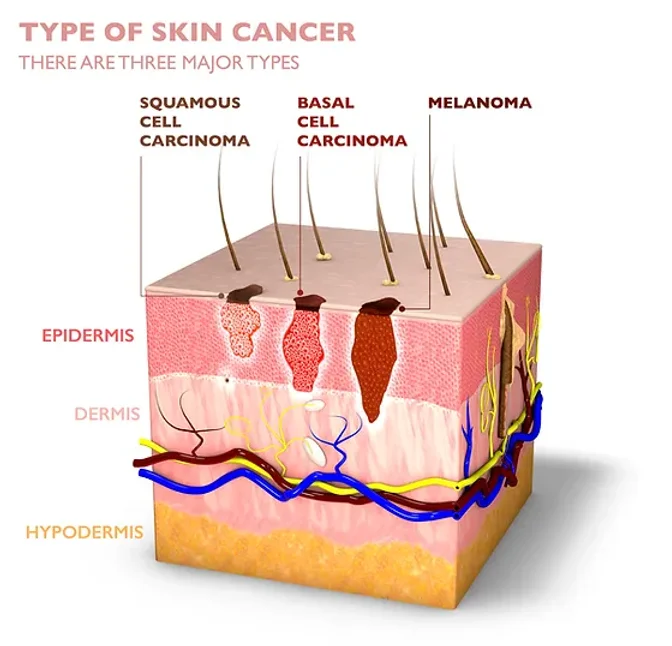 Squamous Cell Carcinoma (SCC)...as bad as melanoma?