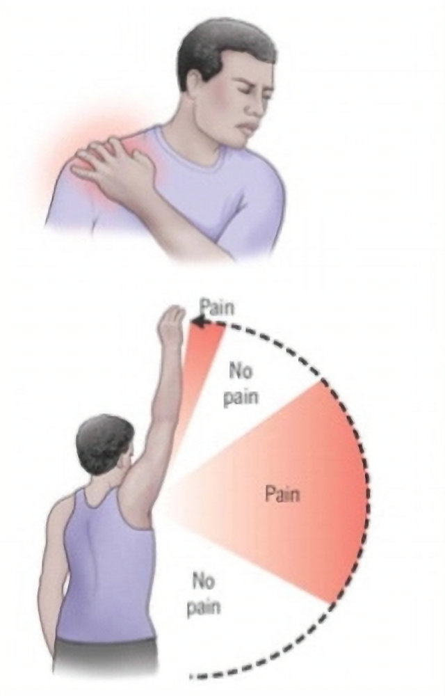 What interventions are good for subacromial shoulder pain??