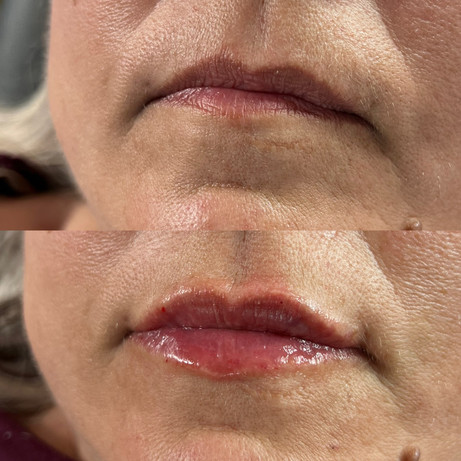 HOME | Maxwell Aesthetics | Salem, OR Injections