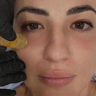 Effective PRP Treatment Brisbane: A Comprehensive Guide