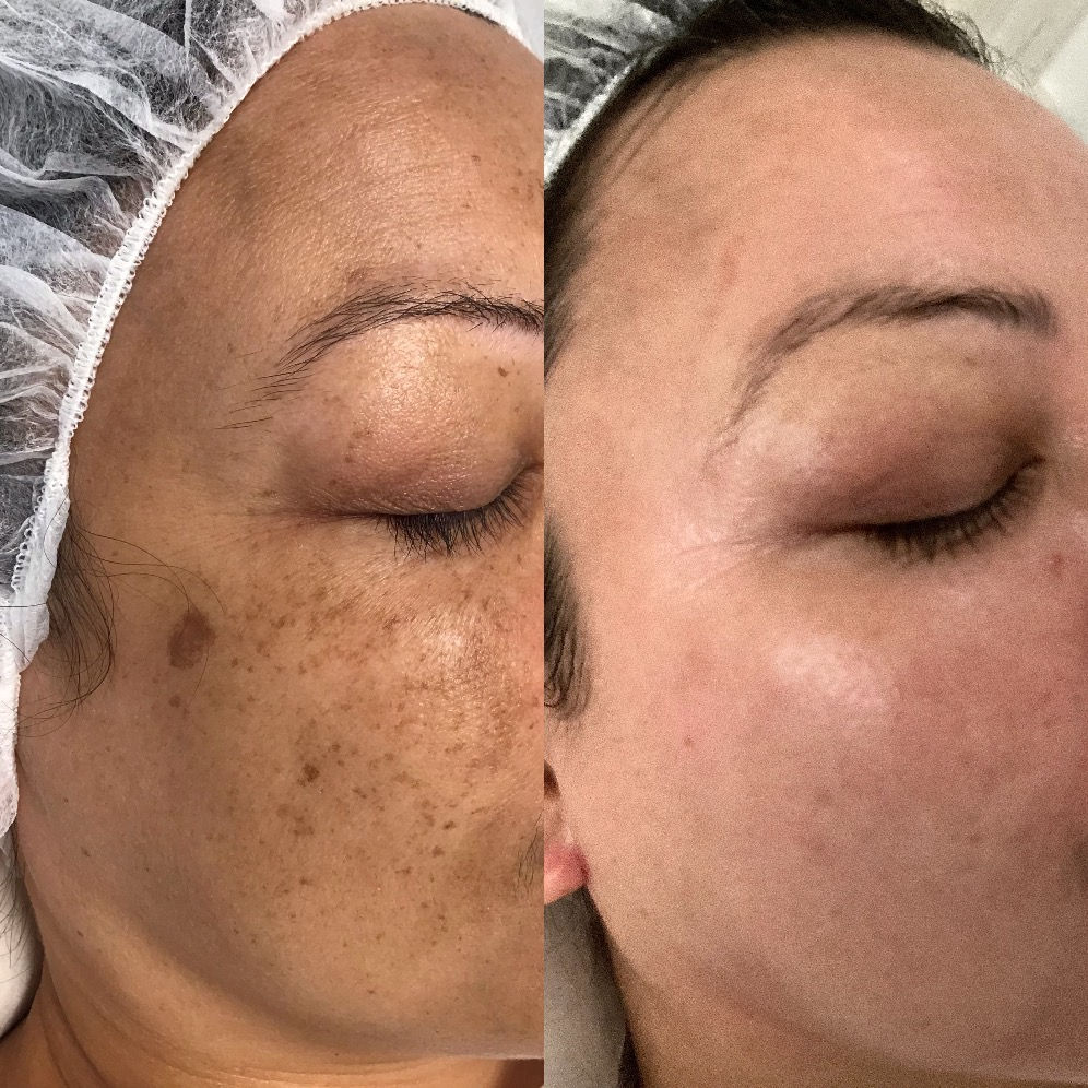 What is Hyperpigmentation and How to Reduce It