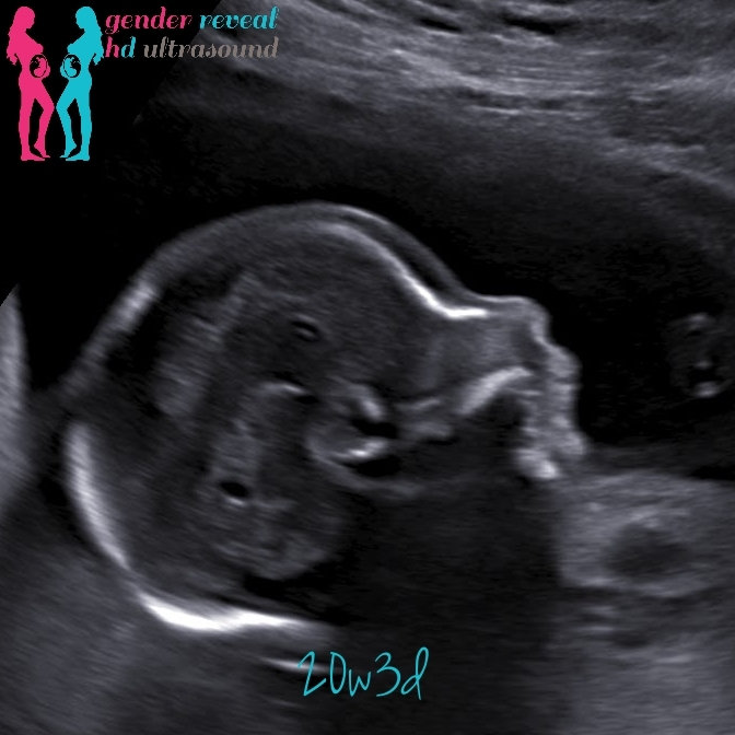 2nd + 3rd trimester 2d | Gender Reveal HD 3D 4D Ultrasound