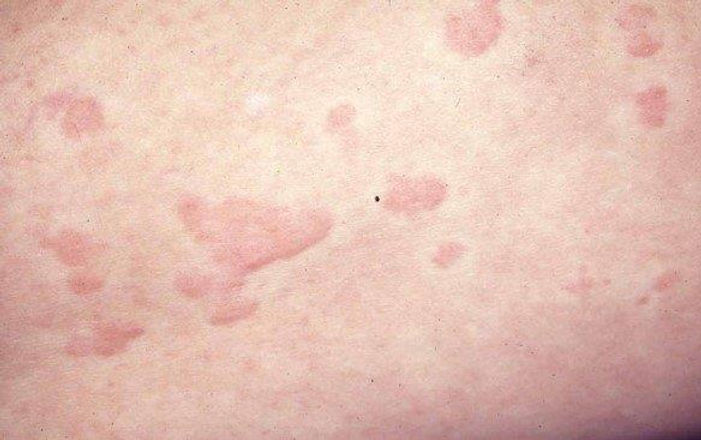 Skin dendritic cells and sustained background IL-13 may be allergy key