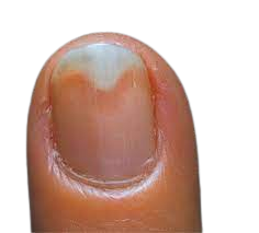 Onycholyse (Nagelablösung) | Nailvision Nagellexikon