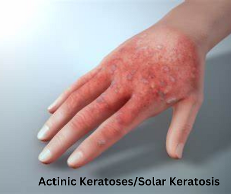 Actinic keratosis(AK) | SPFCR