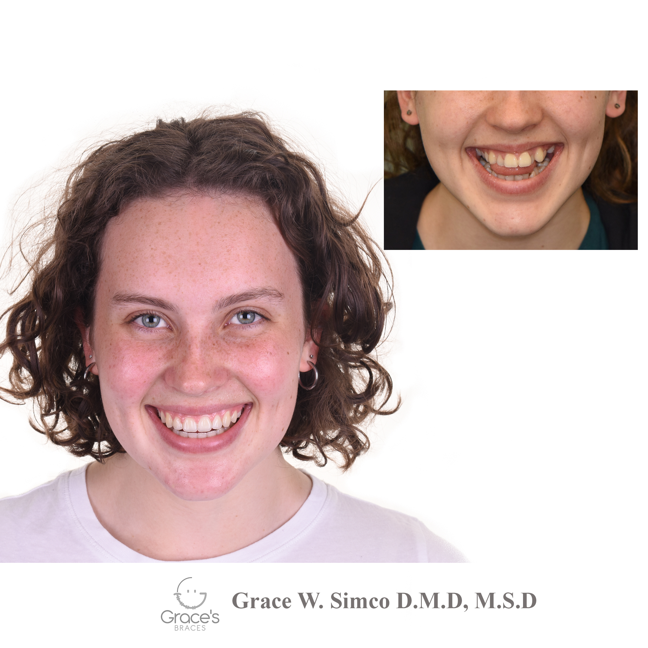 Orthodontic Extraction vs. non-extraction