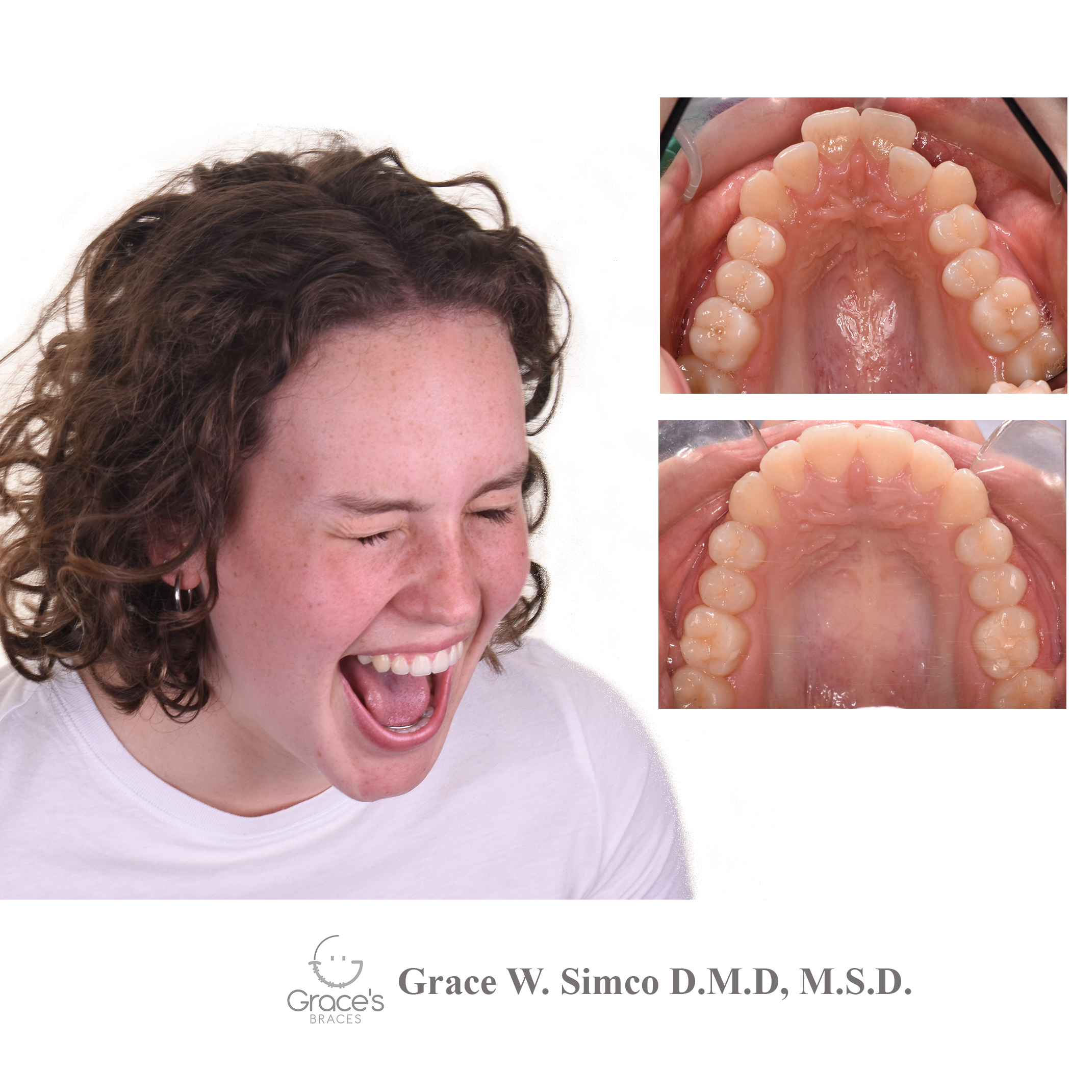 Orthodontic Extraction vs. non-extraction