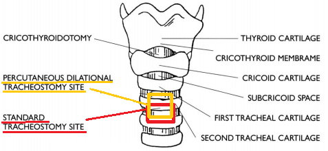 Tracheostomy Care
