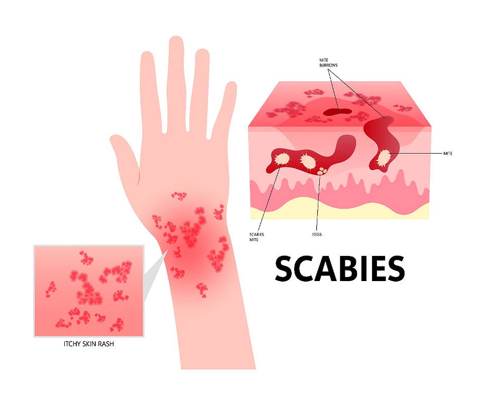 Signs of scabies on your skin