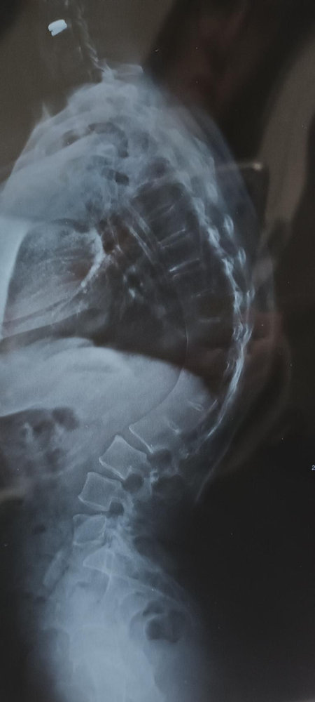 Scoliosis with Kyphosis: A Challenging Crooked Spine