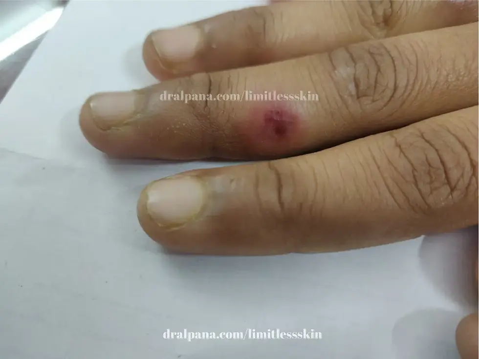 Sac Spider Bite: Symptoms, Treatment, and Prevention