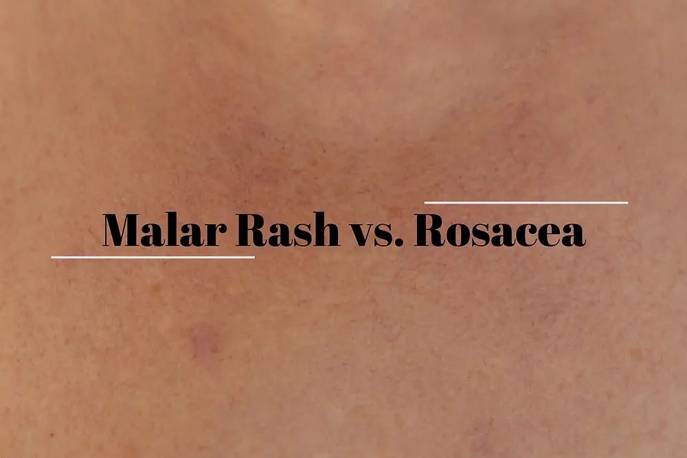 Malar Rash AKA Butterfly Rash AKA Lupus Rash vs. Rosacea