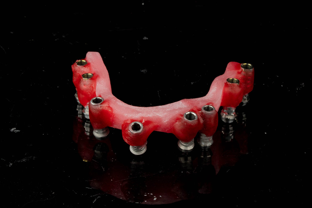 Verification Jigs, the step not to skip when restoring multiple implants