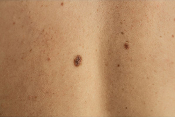 Un caso clínico destaca los desafíos y avances en el tratamiento del ...