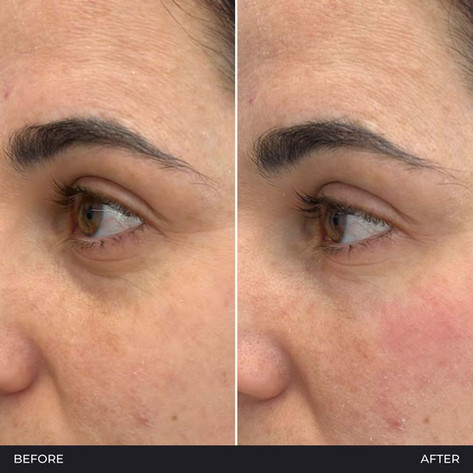 Before and After Polynucleotide treatment | Ameela Treatment Results